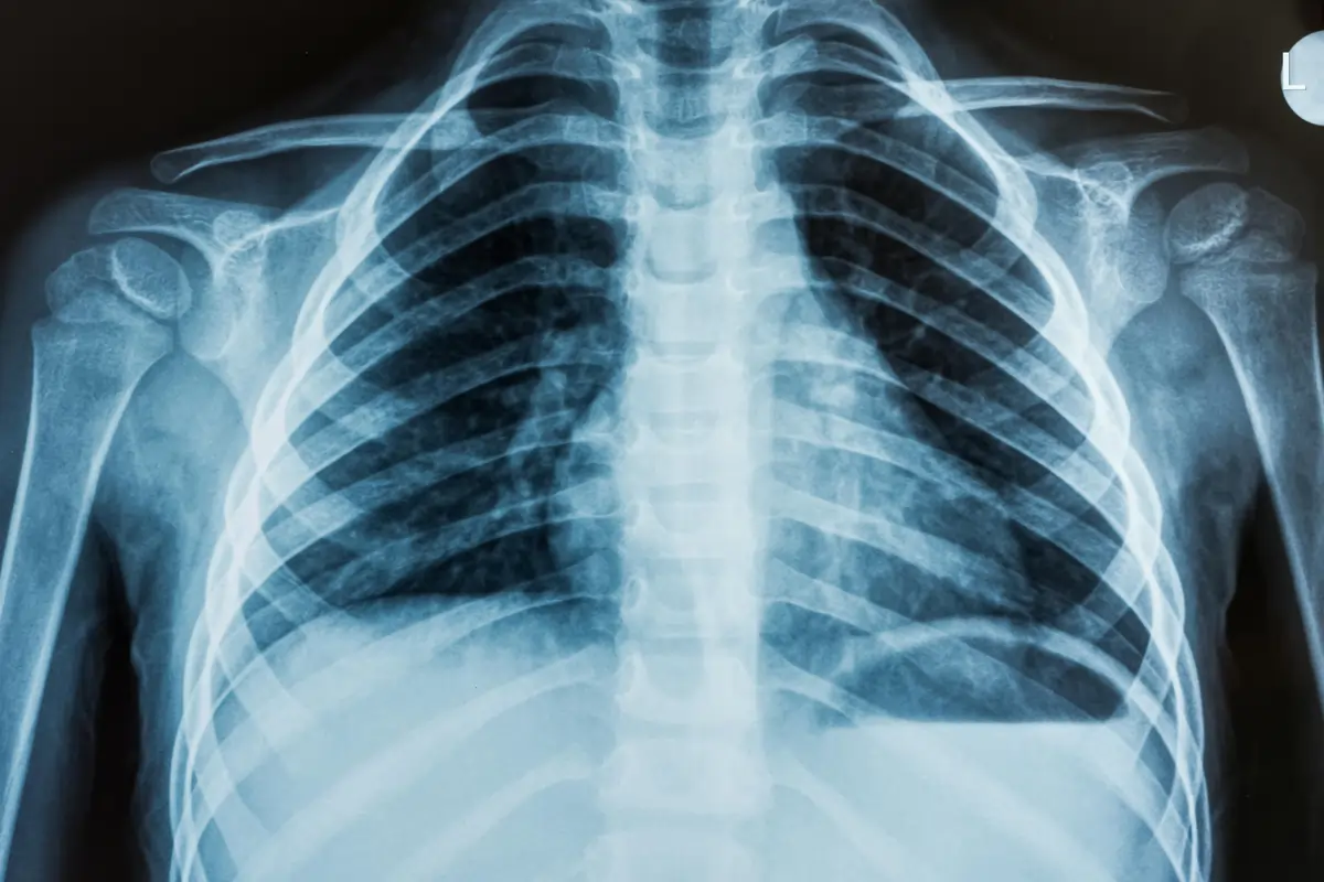 X-Ray - International Limb lengthening center of IRAN