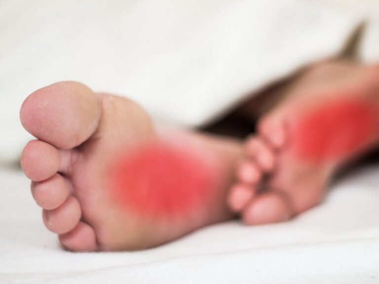 What Causes Heat or Burning Sensation in the Feet? Diagnosis, and ...