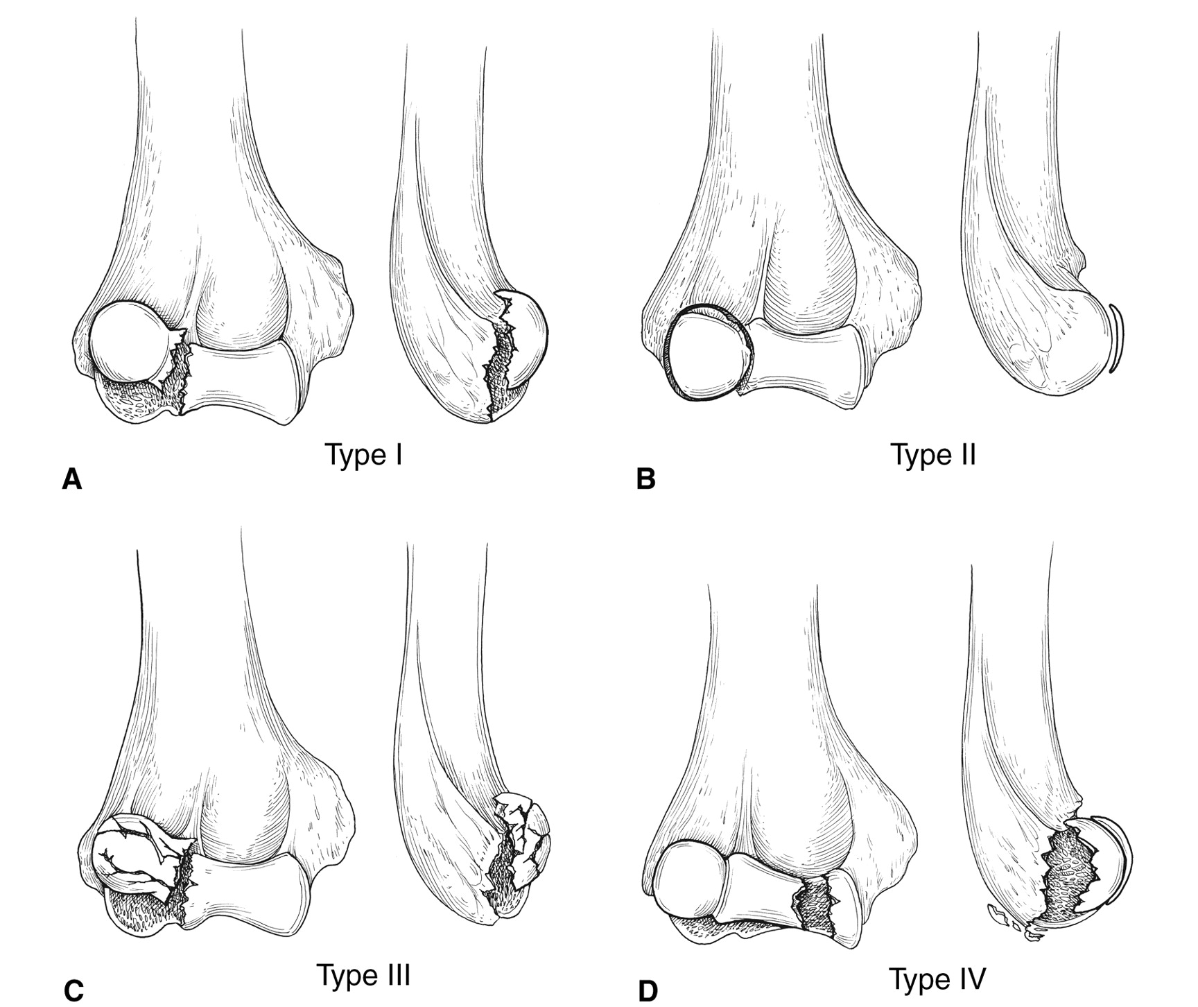 Elbow Capitellum Fractures - International Limb lengthening center of IRAN