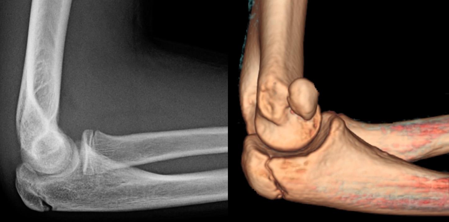 Internal Epicondyle Fracture of the Elbow - International Limb ...