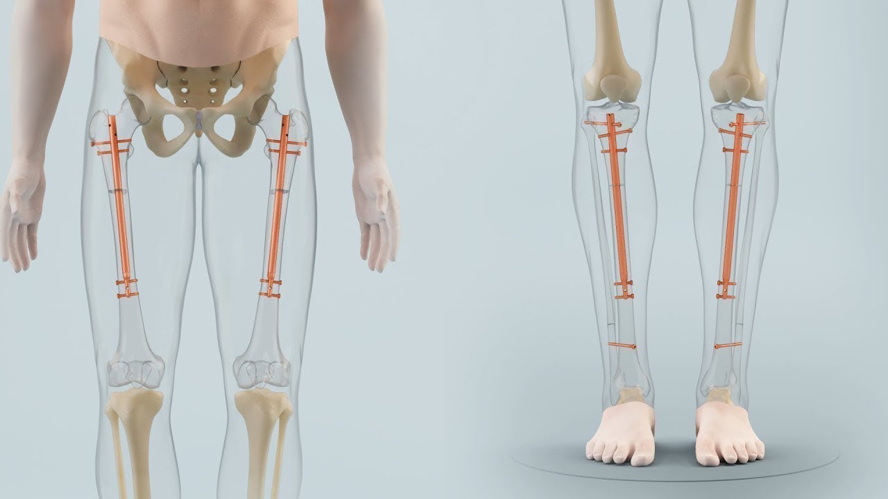 The Key Milestones in Limb Lengthening Surgery: Transformative Moments ...
